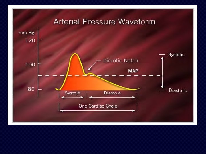 IABP Intraaortic balloon pump counterpulsation Acute circulatory support