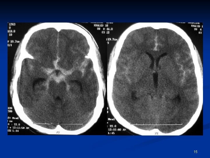 Radiology of common brain diseases 366 RAD 1