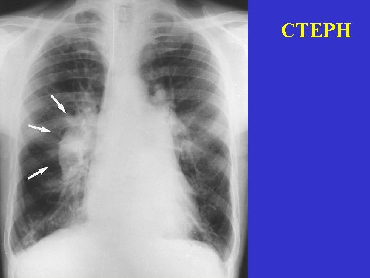 Pulmonary embolism pulmonary hypertension cor pulmonale chronicum Attila