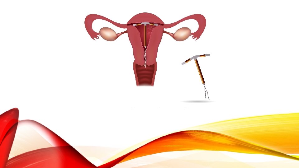 ABNORMAL UTERINE BLEEDING TAMER A HOSNY ASSOCIATE PROFESSOR
