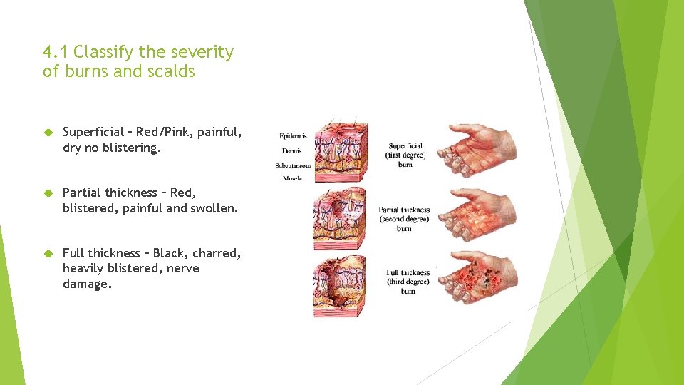 Know how to manage a patient with burns