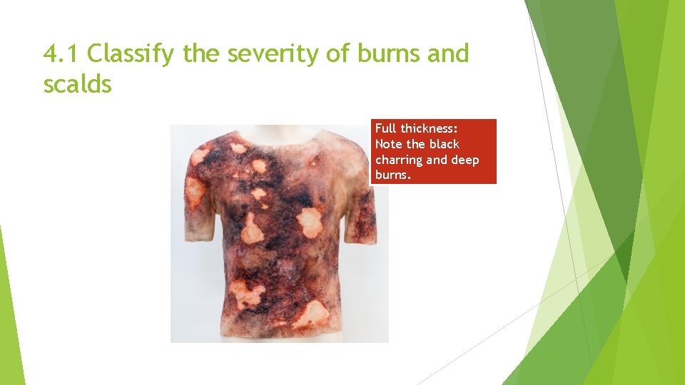 Know how to manage a patient with burns