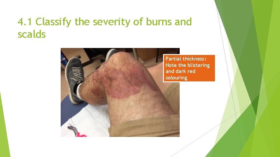 Know how to manage a patient with burns