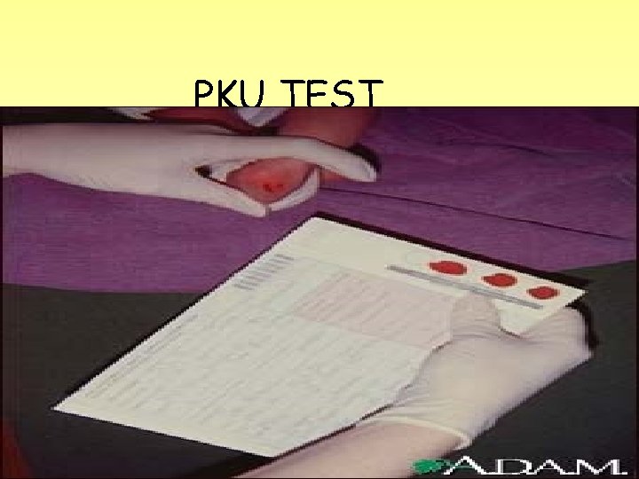 DISORDERS OF AMINO Acids Metabolism DISORDERS OF AMINO