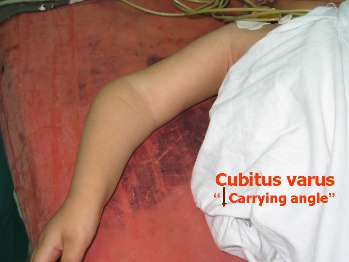 UPPER LIMB FRACTURES FRACTURES CLINICAL PICTURE INVESTIGATIONS TREATMENT