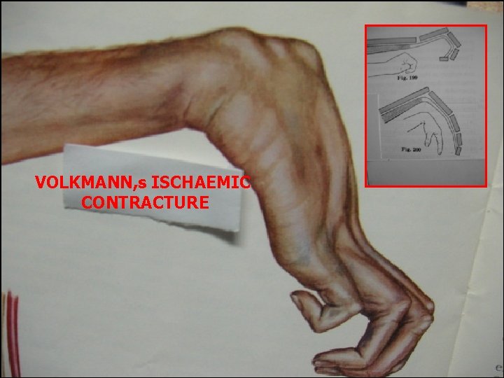 UPPER LIMB FRACTURES FRACTURES CLINICAL PICTURE INVESTIGATIONS TREATMENT