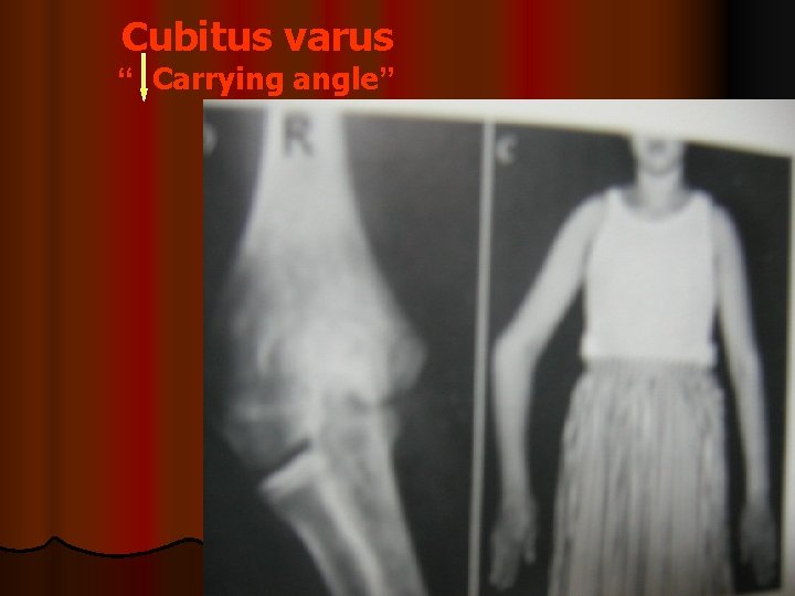 UPPER LIMB FRACTURES FRACTURES CLINICAL PICTURE INVESTIGATIONS TREATMENT