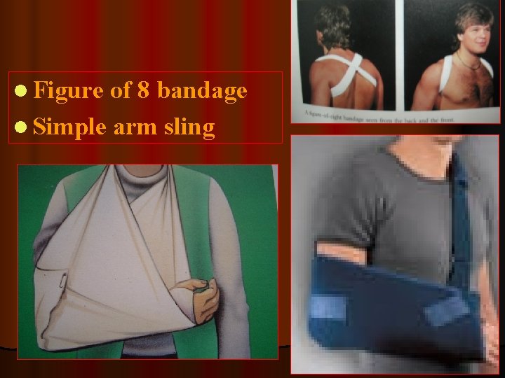 UPPER LIMB FRACTURES FRACTURES CLINICAL PICTURE INVESTIGATIONS TREATMENT