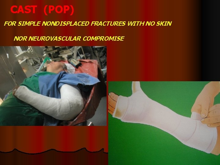 UPPER LIMB FRACTURES FRACTURES CLINICAL PICTURE INVESTIGATIONS TREATMENT