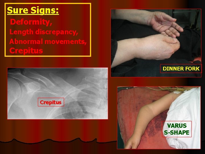UPPER LIMB FRACTURES FRACTURES CLINICAL PICTURE INVESTIGATIONS TREATMENT