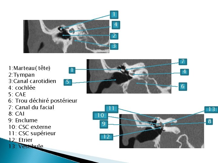 Radioanatomie TDM et IRM du rocher R Labbioui