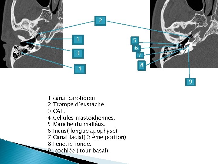 Radioanatomie TDM et IRM du rocher R Labbioui