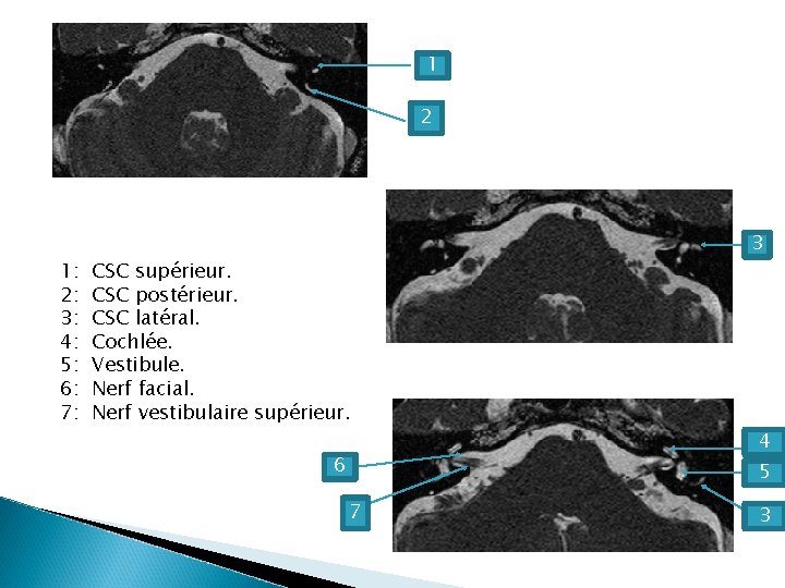 Radioanatomie TDM et IRM du rocher R Labbioui