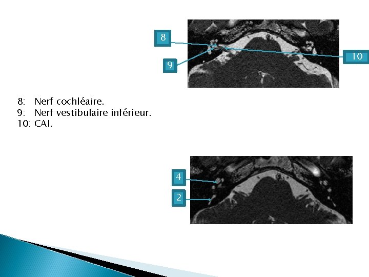 Radioanatomie TDM et IRM du rocher R Labbioui