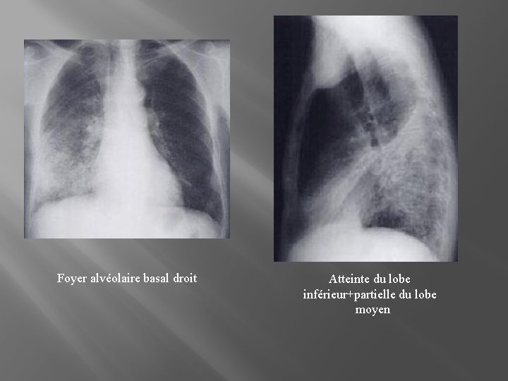 SYNDROME ALVOLAIRE PLAN Introduction Base anatomique Pathognie Moyens