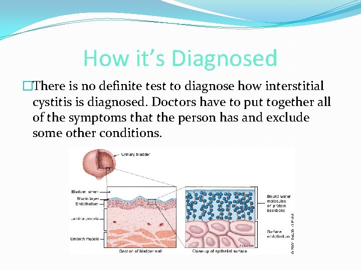 Interstitial Cystitis Painful Bladder Syndrom By Katherine Daschke