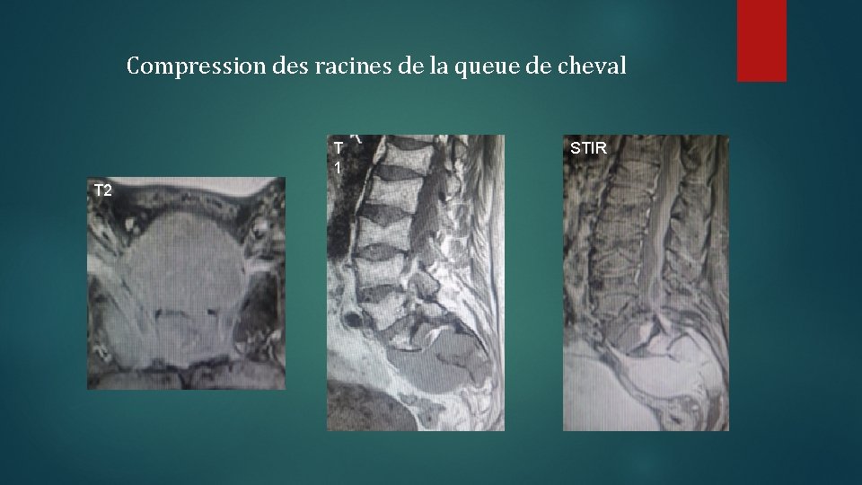APPORT DE LIRM VERTEBROMDULLAIRE DANS LE DIAGNOSTIC ET