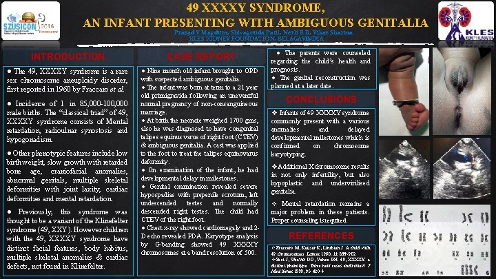 49 XXXXY SYNDROME AN INFANT PRESENTING WITH AMBIGUOUS