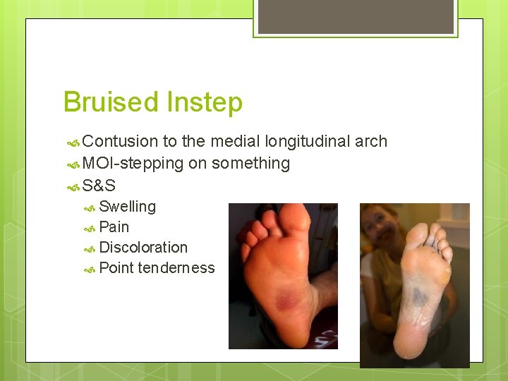 Foot and Ankle Injuries Blisters friction causing fluid