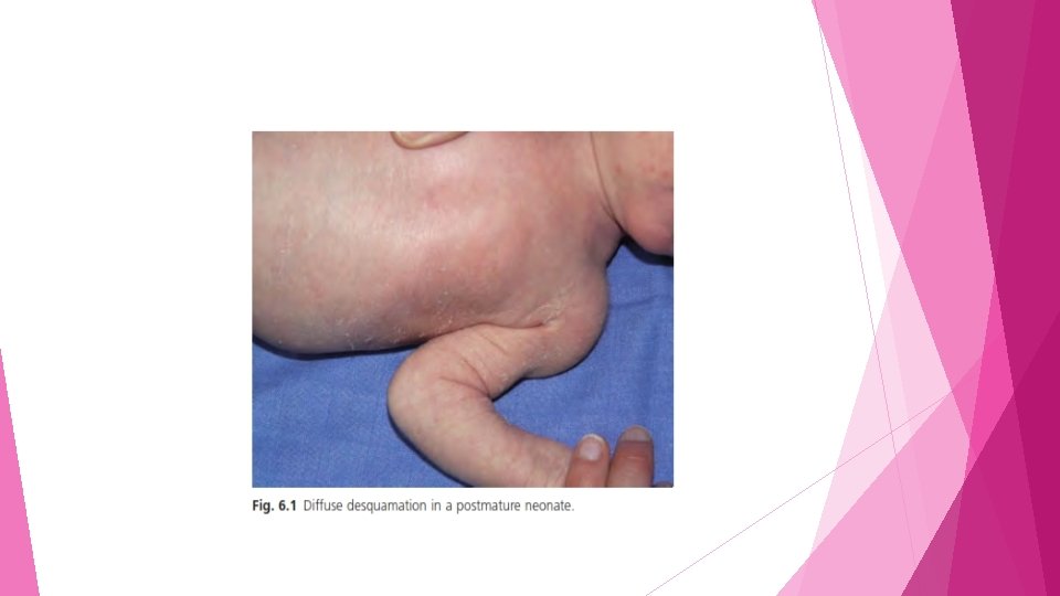 Common Transient Neonatal Dermatoses Harpers Textbook of Pediatric