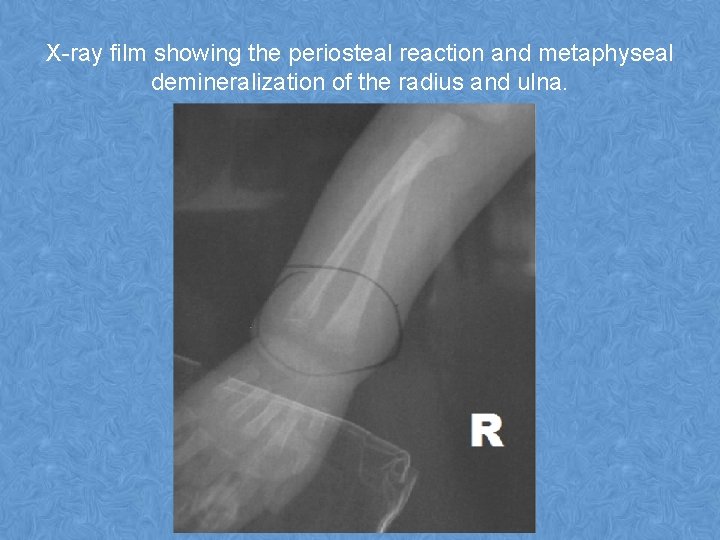 CASE OF A RARE DISEASE EARLY CONGENITAL SYPHILIS