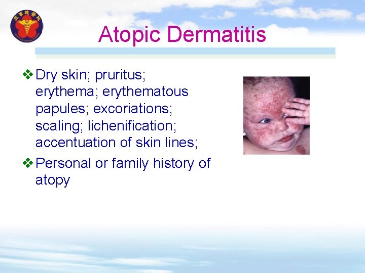 Atopic Dermatitis v Dry skin pruritus erythematous papules