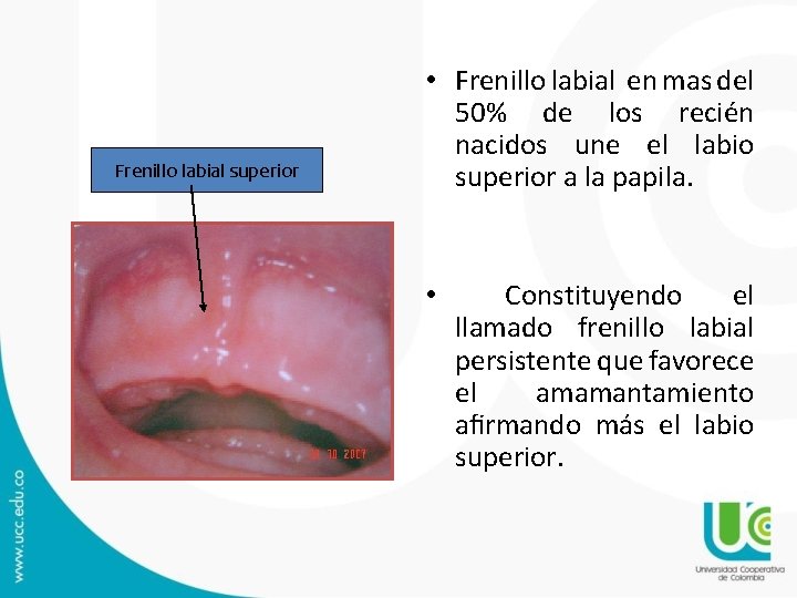 PATOLOGIA ORAL DEL RECIEN NACIDO IRINA CALLE CARLOS