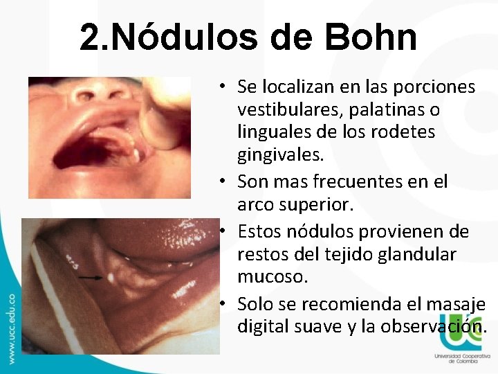 PATOLOGIA ORAL DEL RECIEN NACIDO IRINA CALLE CARLOS