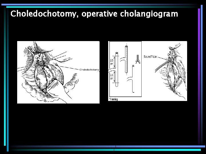 SURGICAL TECHNIQUES FOR CHOLECYSTECTOMY By Brig Abrar Hussain