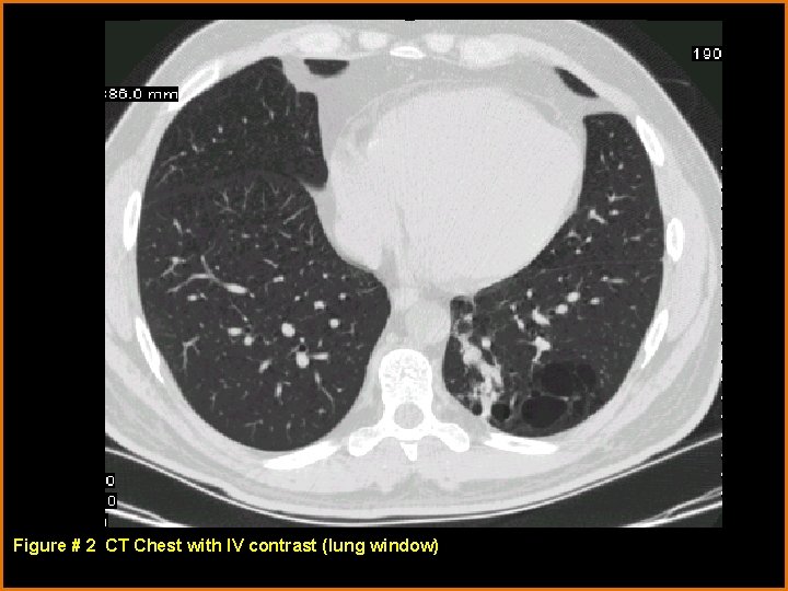 Radiological Category Thoracic Chest Principal Modality CT Case