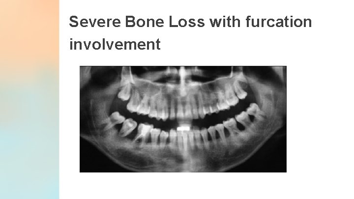 Periodontal Disease Horizontal and vertical bone loss localized