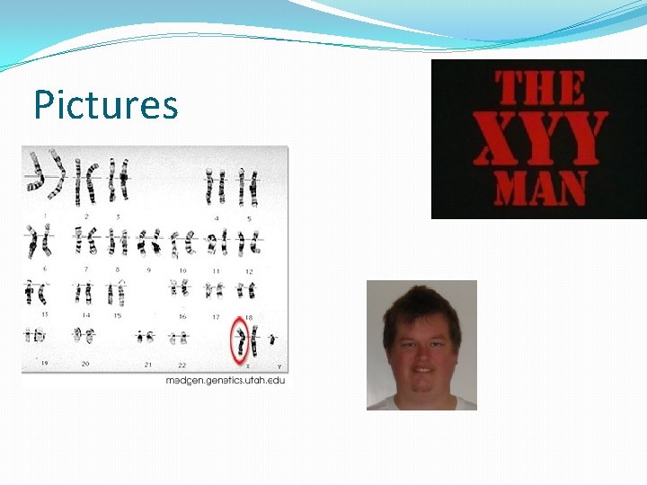 XYY Syndrome or Jacobs syndrome By josh Korper