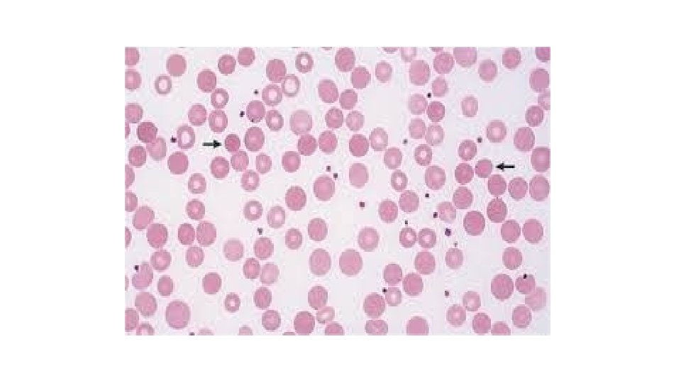 RED CELL MEMBRANE DISORDERS Dr Ali Khazaal Jumaa