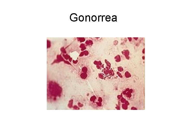 Gonorrea Gonorrea La gonorrea o blenorragia una malattia