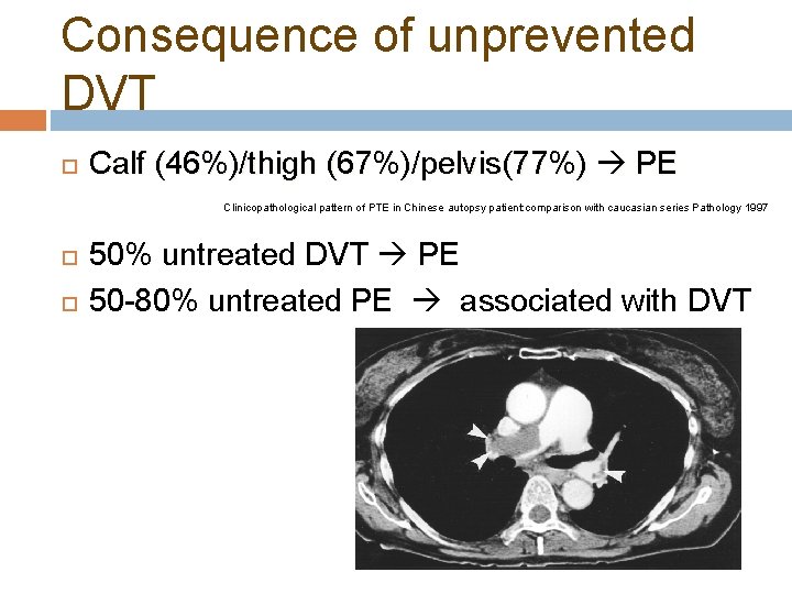 Deep Vein Thrombosis and Pulmonary Embolism prophylaxis in
