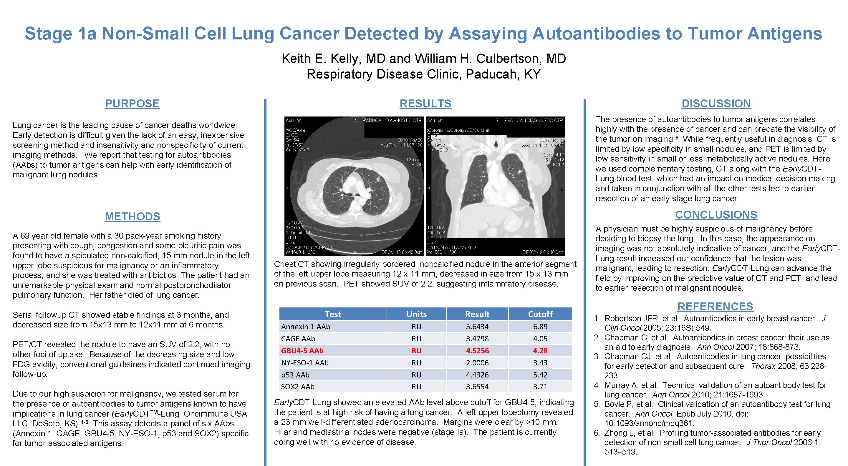 Stage 1 a NonSmall Cell Lung Cancer Detected