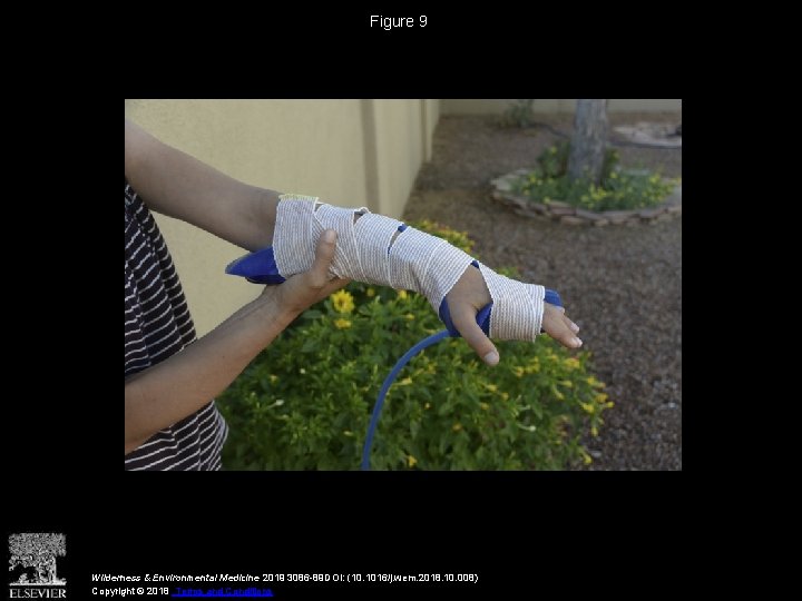 Improvised Hydration Bladder Air Splint A Wilderness Case