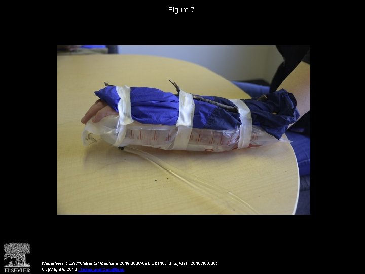 Improvised Hydration Bladder Air Splint A Wilderness Case