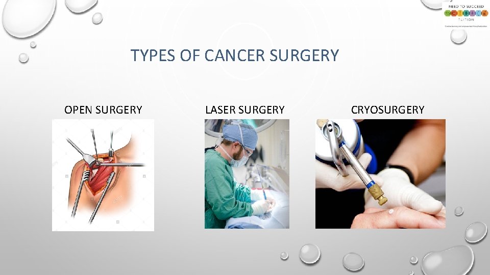 UNDERSTANDING CANCER PART 3 CANCER TREATMENT HOW SURGERY
