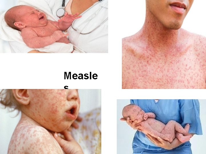 Miscellaneous Infections Topic 15 Dr Gayathri Attanayake MBBS