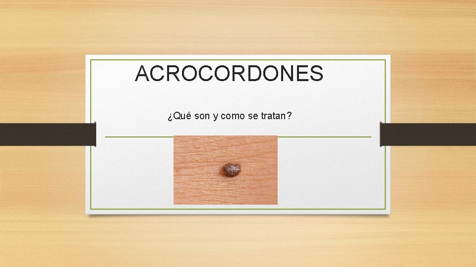 ACROCORDONES Qu son y como se tratan Causas