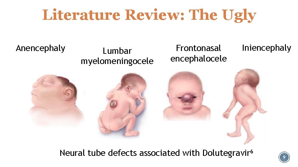 Neural Tube Defects with Dolutegravir at the Time