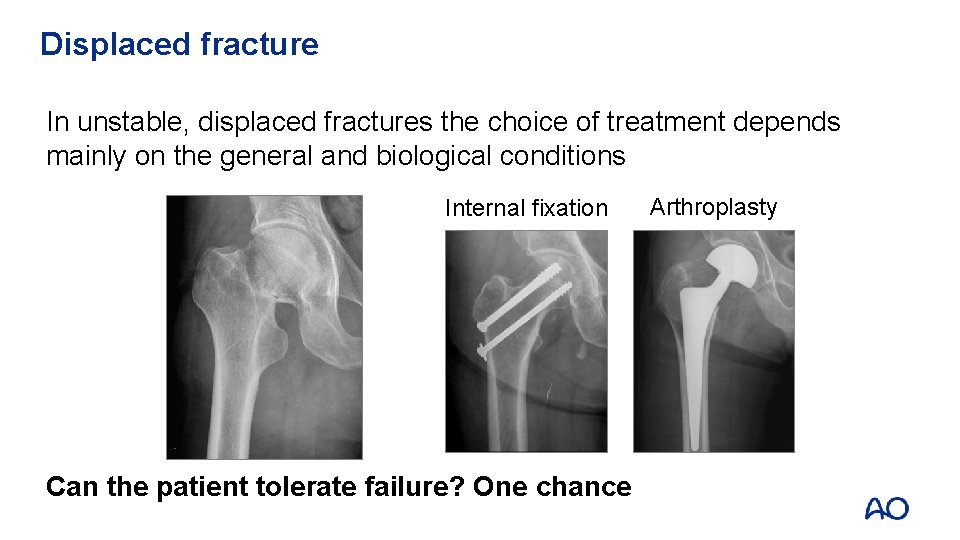 Femoral neck fractures Learning objectives Classify femoral neck