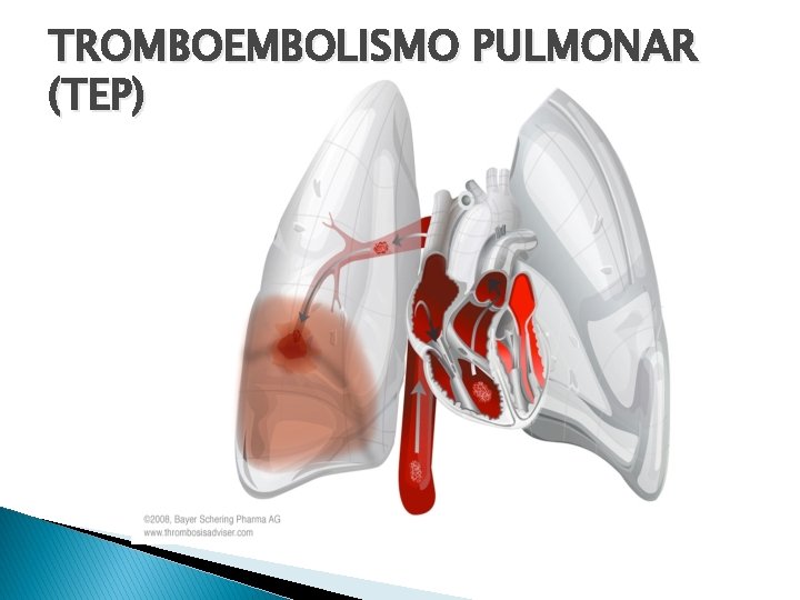 ATELECTASIA EDEMA PULMONAR Y TROMBOEMBOLISMO PULMONAR ATELECTASIA El