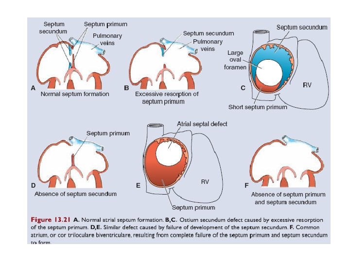 Lecture 56 Development of Heart II Learning Objectives