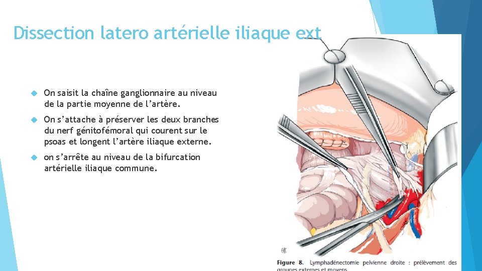 Curage pelvien 3 groupes ganglionnaires ganglions inter iliaques