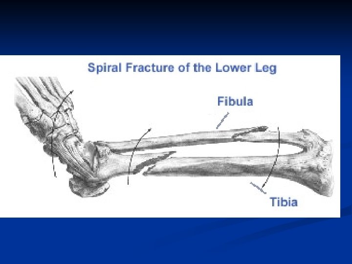 Principles of fractures A fracture is a break