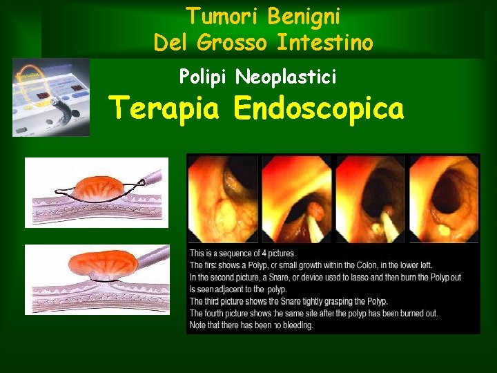Tumori Benigni Del Grosso Intestino Polipi Neoplastici Terapia