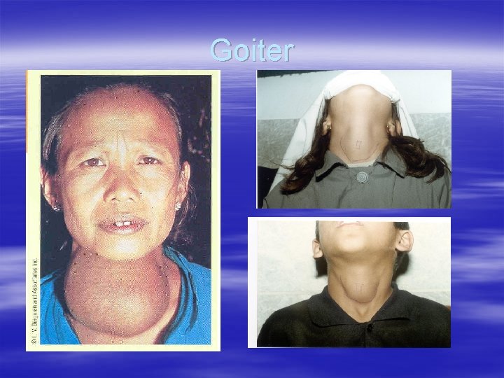 Iodine in human health Iodine Deficiency Disorderes Iodine