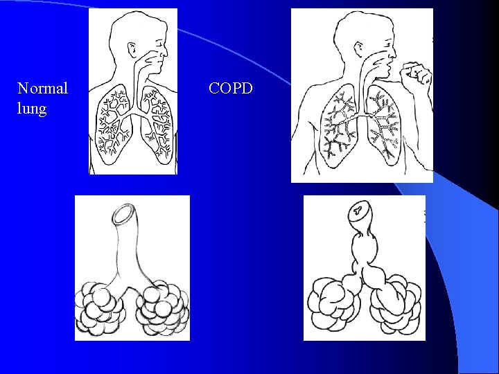 Chronic Obstructive Pulmonary Disease E Sevda zdoan MD